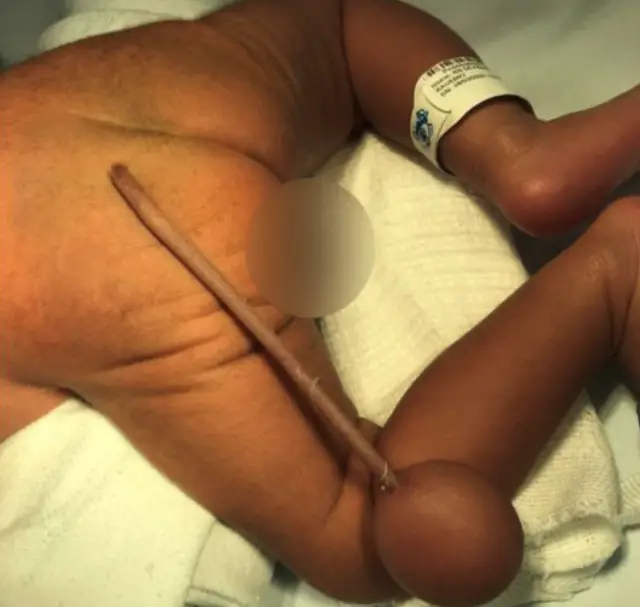 9 Real Cases Of Babies Born With Tails - Detailed Reports - Odd News ...